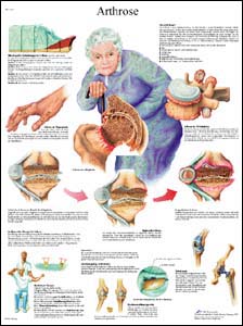 Lehrtafel - Arthrose - Reinhold Schulausstattung e.K.